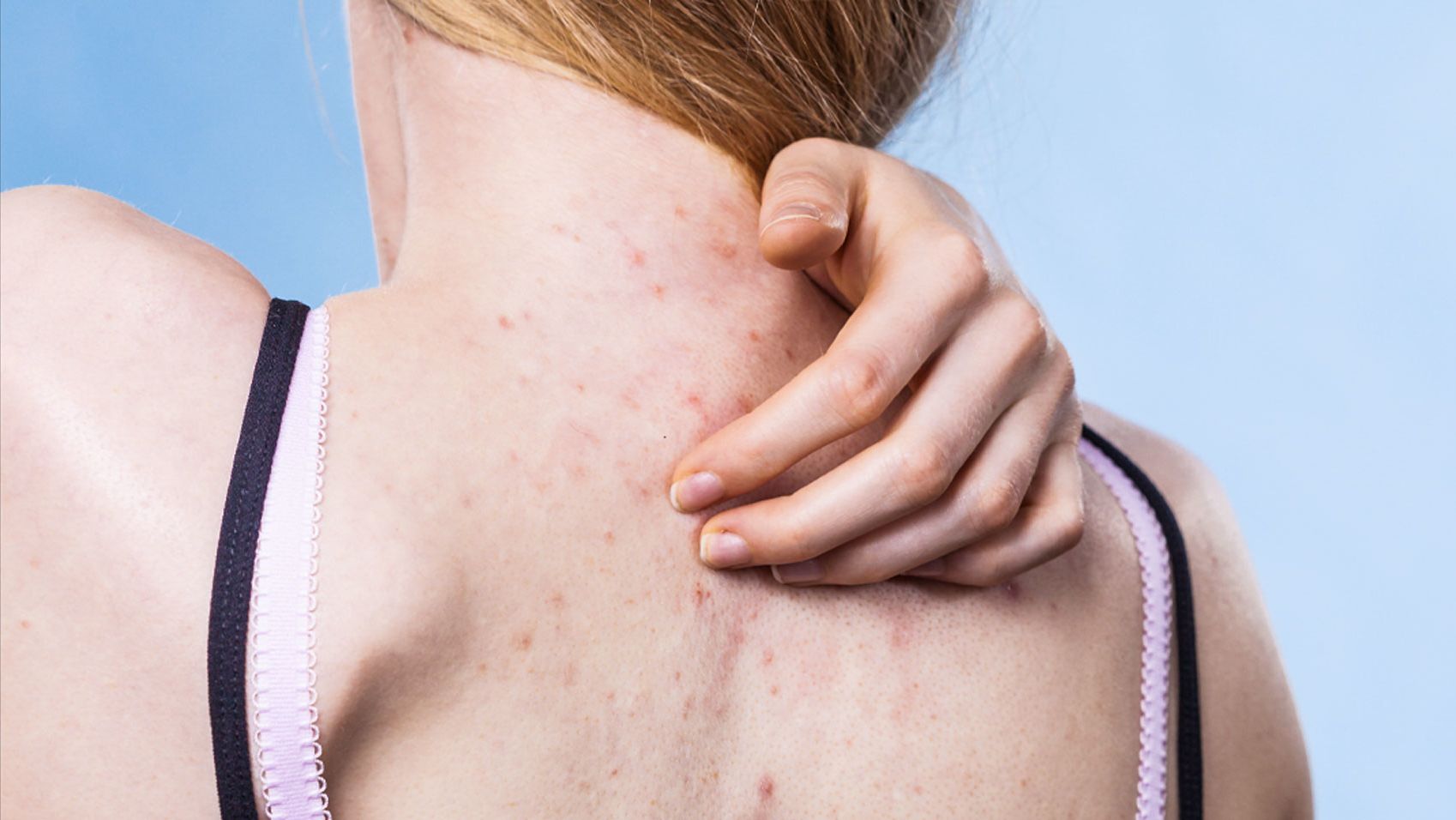 10 Tips To Get Rid Of Body Acne And Bring Back Your Confidence Top