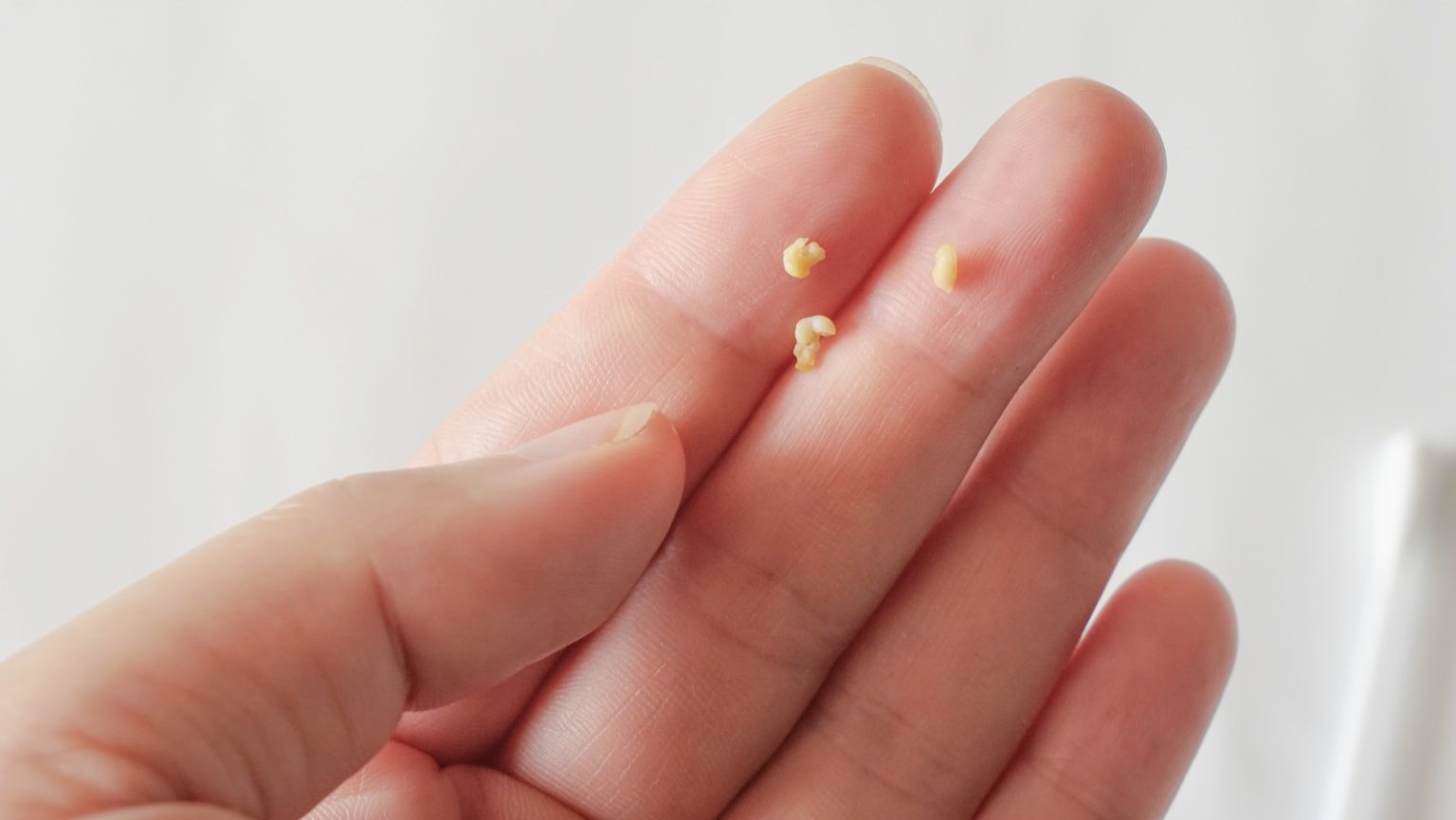 Everything you need know about tonsil stones, odd growths that seem ...