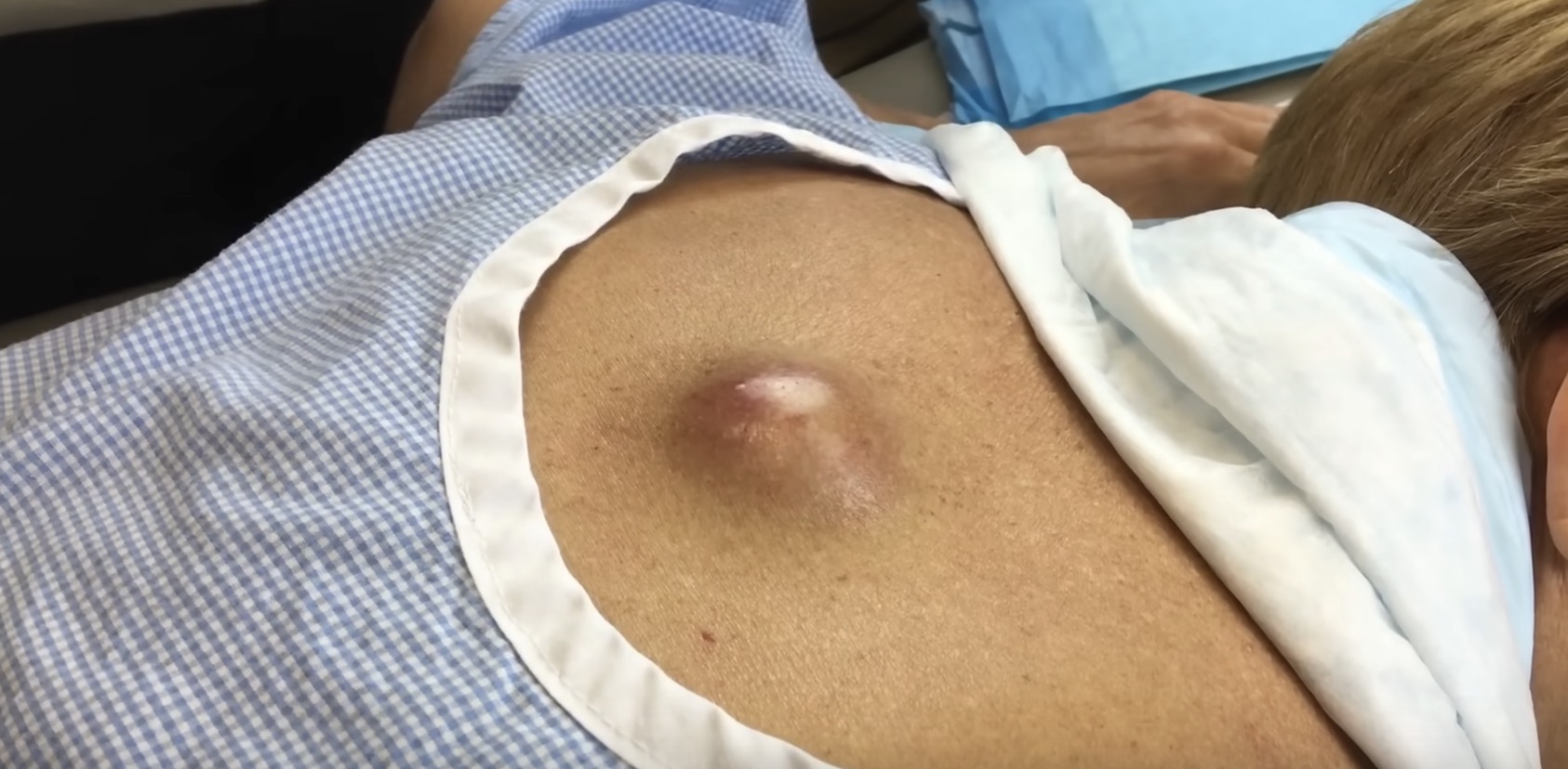 Removal of Infected Cyst on Mid-back: Watch the Procedure - Top Stories