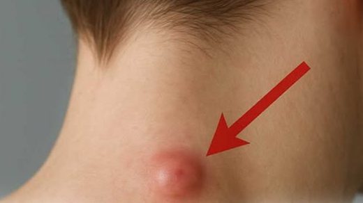 Got a lump on your neck, back or behind your ear? Then you need to know ...