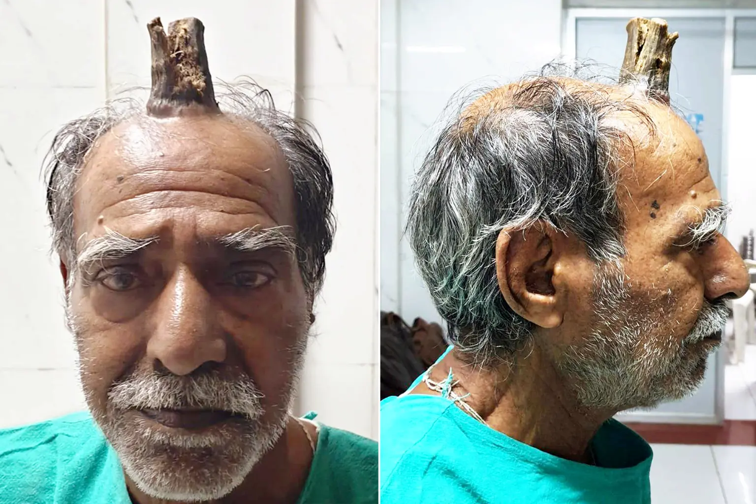 Four-inch 'devil horn' removed from Indian man's head. What is this ...